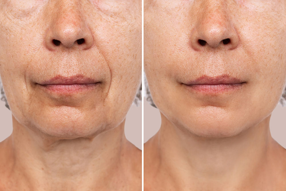 Pflastersteinkinn - BEYOU HAMBURG